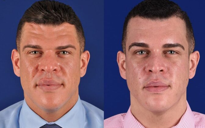 10 Most Common Plastic Surgeries for Men - EDM Chicago