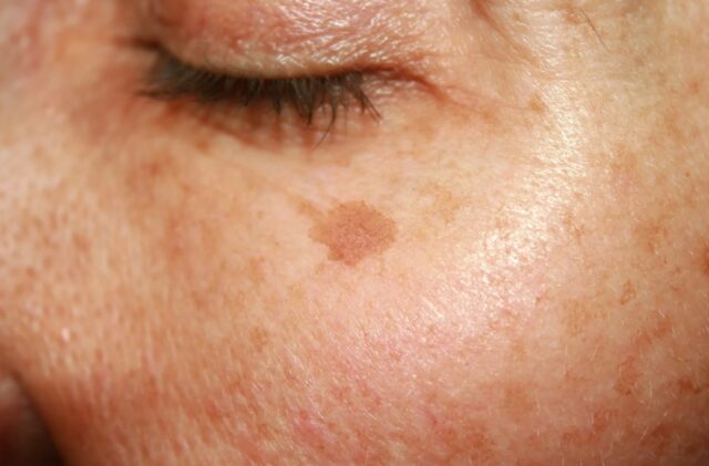 Early Signs To Be Noted In Type 2 Diabetes - EDM Chicago