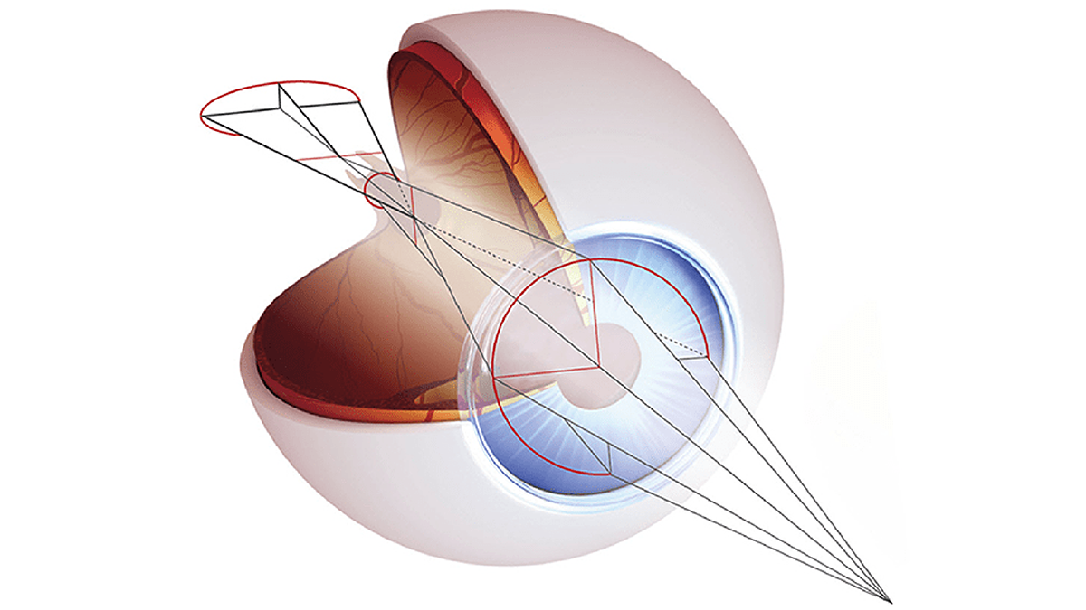 What is a Refractive Lens Exchange Procedure: 3 Risks & 4 Benefits ...