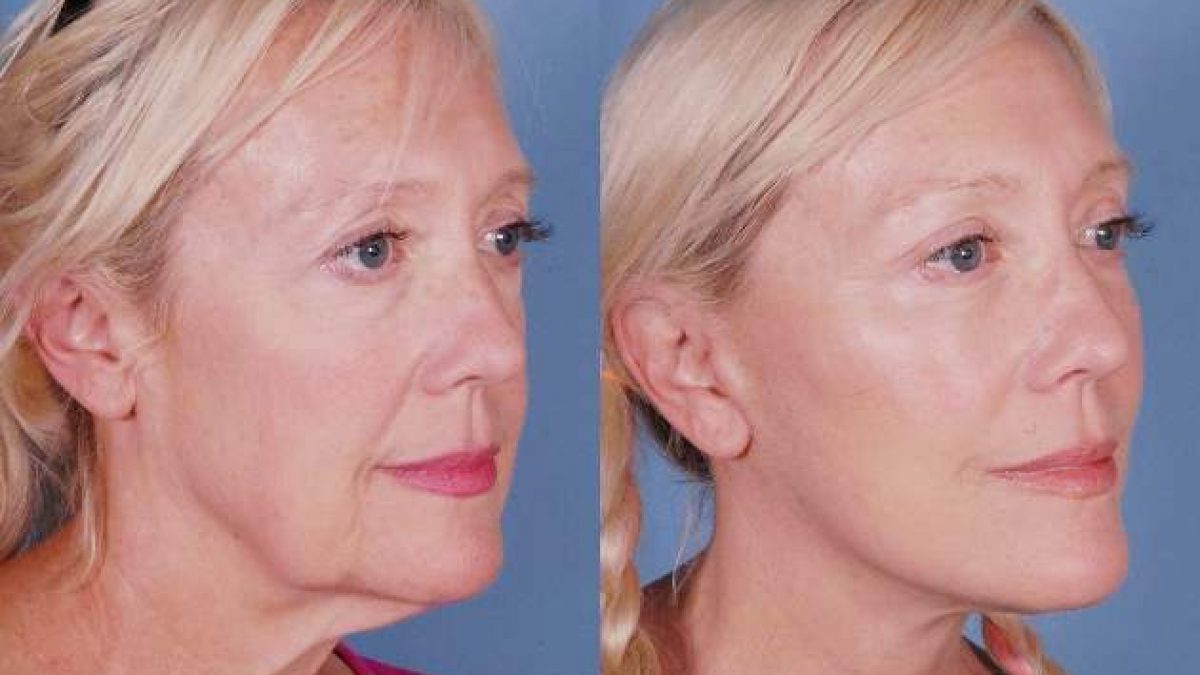 How is Micro-facelift Surgery Performed? - EDM Chicago