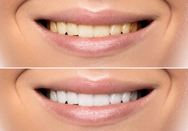 Preserving Your Dental Health: Important Considerations For Teeth ...